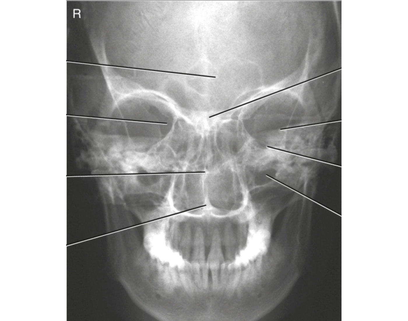 PA Axial (Caldwell) Facial Bones Quiz PA Axial (Caldwell) Facial Bones Quiz