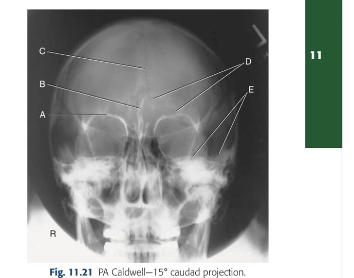 Cranial Bones - PA axial caldwell projection Quiz Cranial Bones - PA axial caldwell projection Quiz