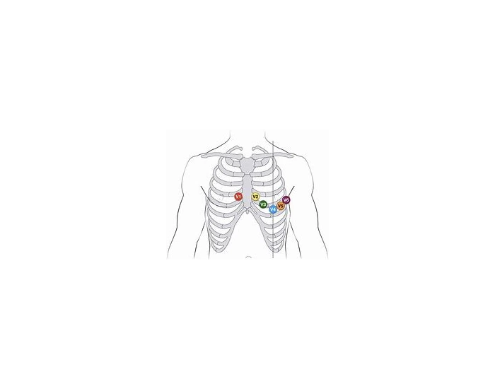 ECG Chest Lead Placement — Printable Worksheet ECG Chest Lead Placement — Printable Worksheet
