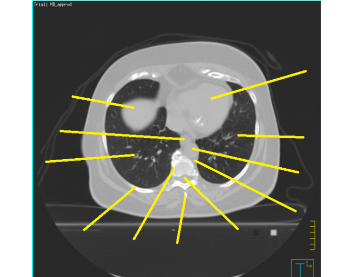 Chest Ct Anatomy Quiz
