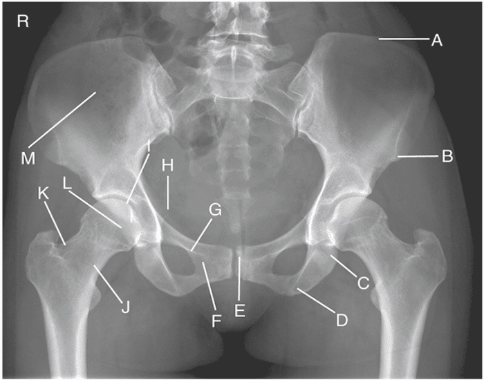 Pelvic Girdle X Ray Anatomy Quiz pelvic-girdle-x-ray-anatomy-quiz