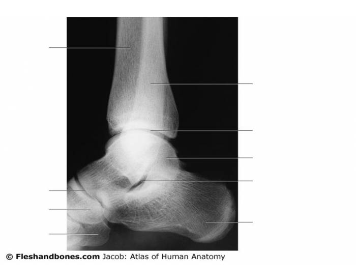 Ankle X Ray Quiz ankle-x-ray-quiz