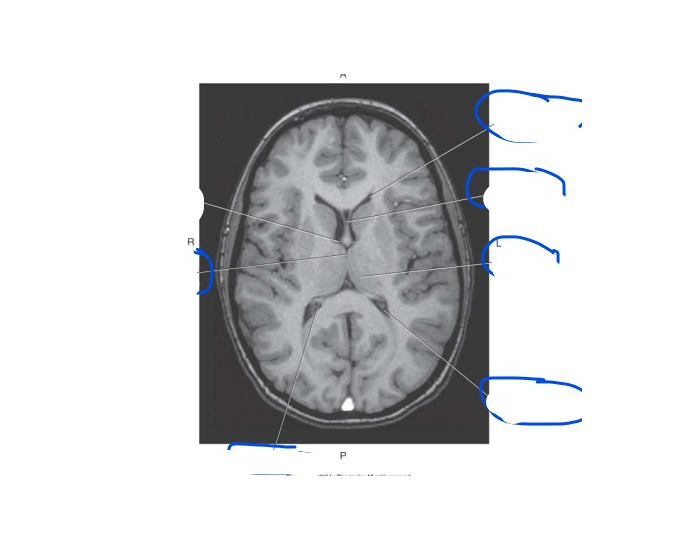 Axial T1 weighted MRI Quiz Axial T1 weighted MRI Quiz