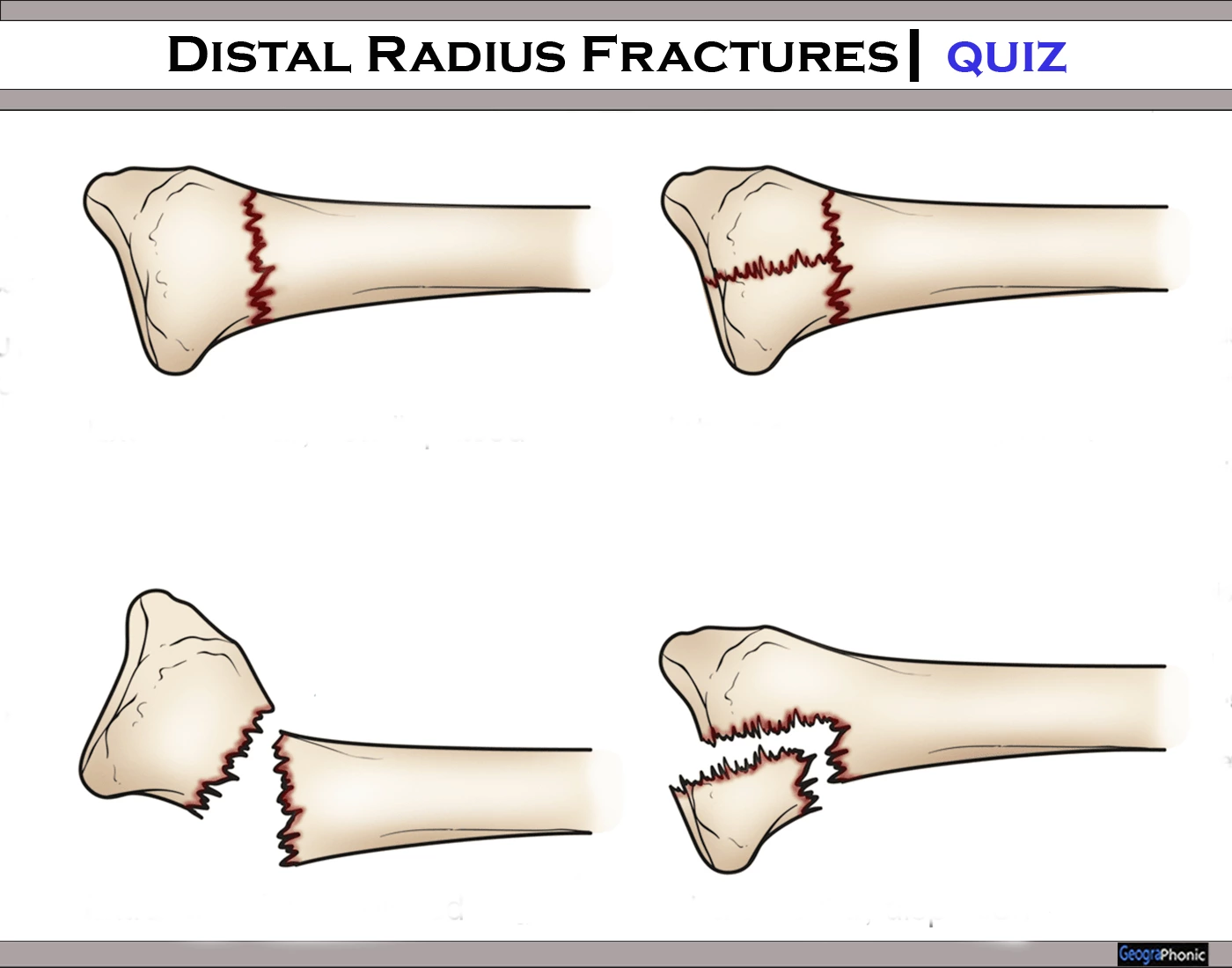 Distal Radius Fractures Quiz