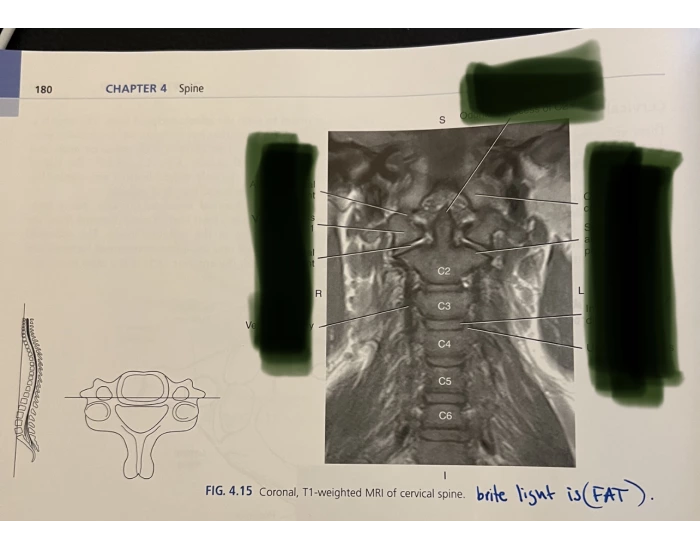 Coronal, T1-Weighted MRI of Cervical Spine Quiz Coronal, T1-Weighted MRI of Cervical Spine Quiz