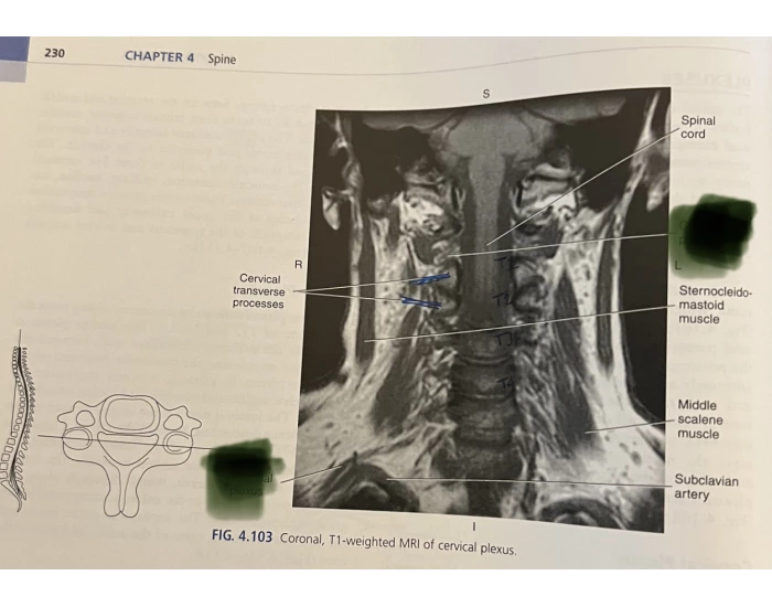 Coronal T1 Weighted MRI of Cervical Plexus Quiz Coronal T1 Weighted MRI of Cervical Plexus Quiz