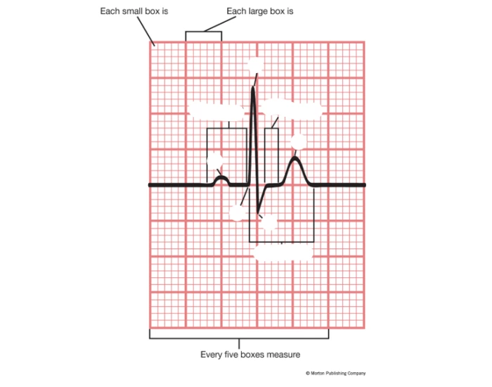 ECG (Simple) — Printable Worksheet ECG (Simple) — Printable Worksheet
