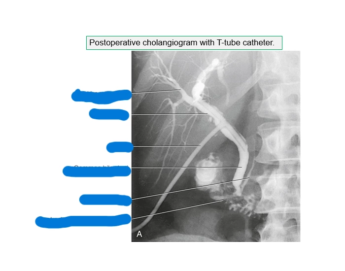 Cholangiogram With T Tube Quiz
