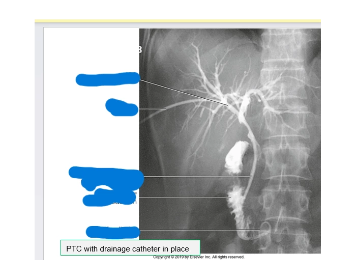 Percutaneous Transhepatic Cholangiography Quiz