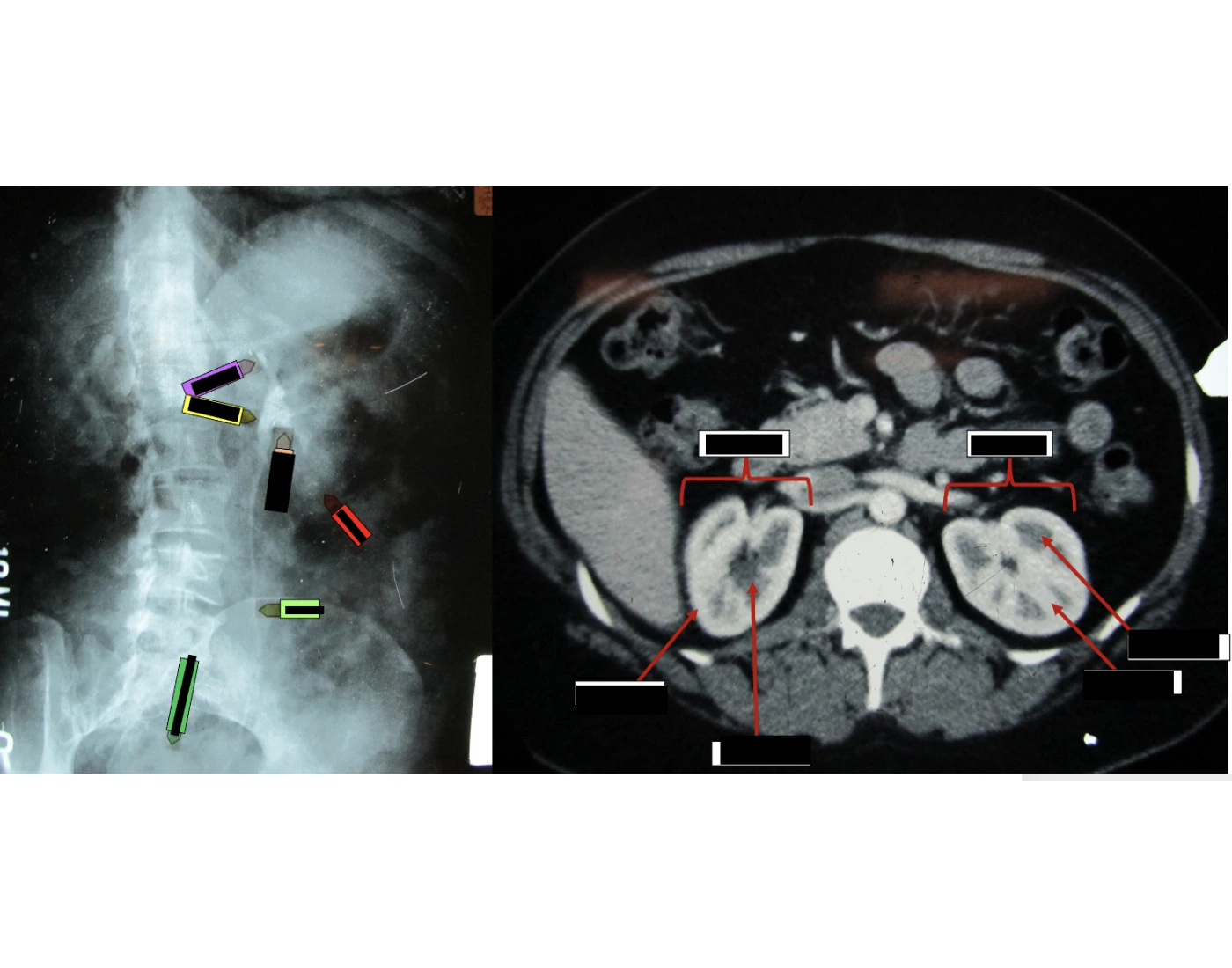 Intravenous Pyelogram Ivp And Urinary Ct Scan Quiz
