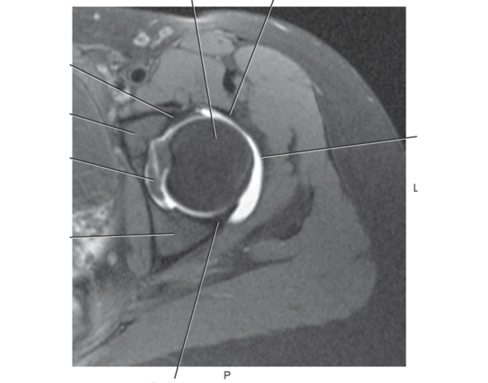 Axial Mri Of Left Hip W Ligaments And Labrum Quiz