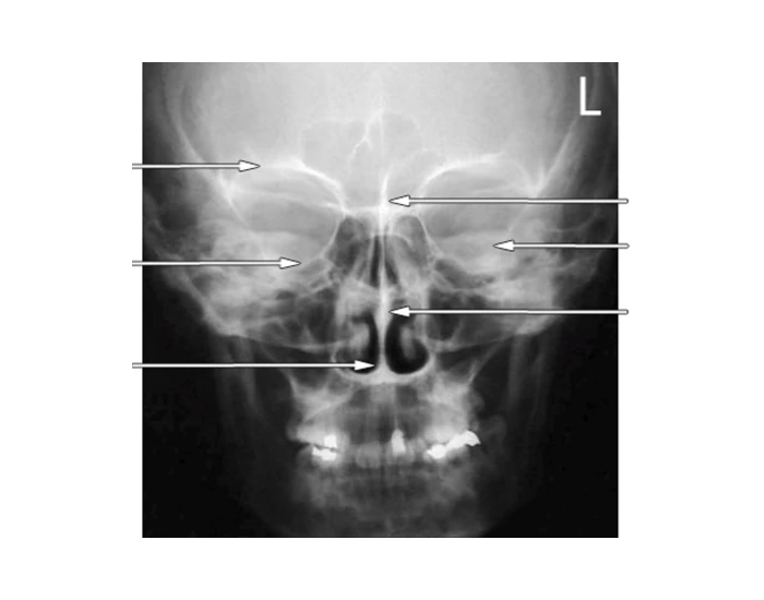 PA Axial Caldwell facial bone Quiz PA Axial Caldwell facial bone Quiz