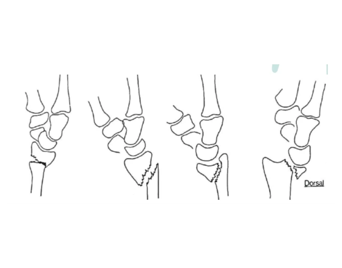 Distal Radius Fractures Human Body Quiz