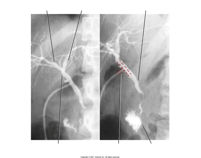 Delayed Or T Tube Cholangiogram Quiz