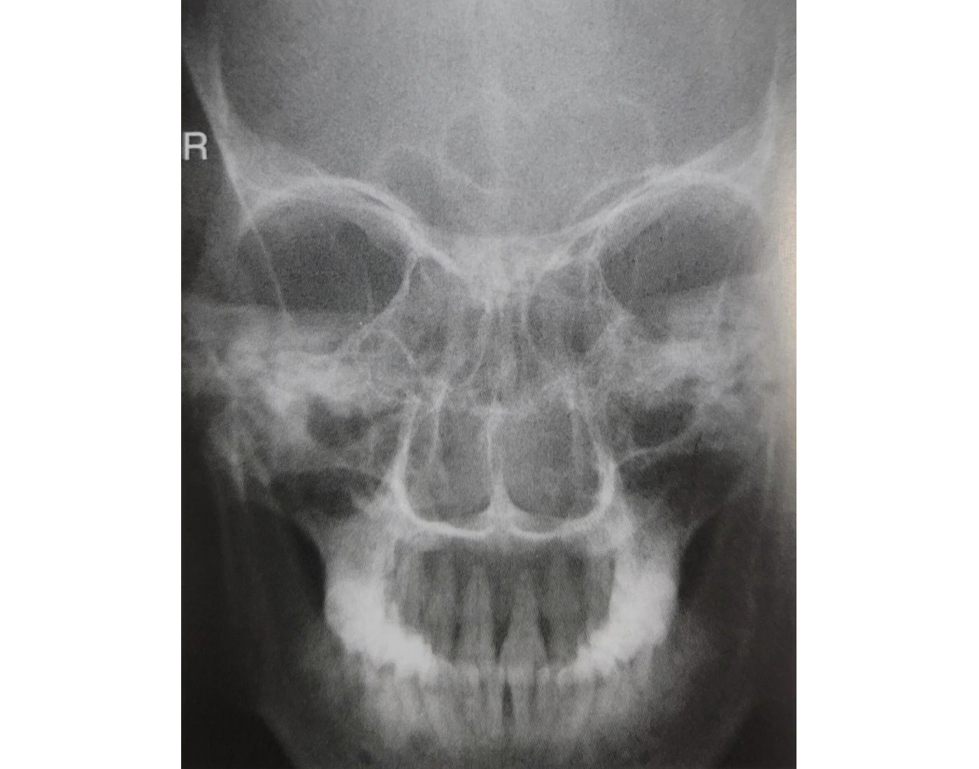 Caldwell method - PA axial projection facial bones Quiz Caldwell method - PA axial projection facial bones Quiz