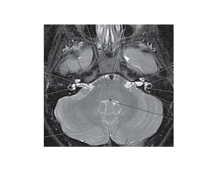 FIG. 3.146 Axial, T2-weighted MRI of facial (CN VI Quiz FIG. 3.146 Axial, T2-weighted MRI of facial (CN VI Quiz