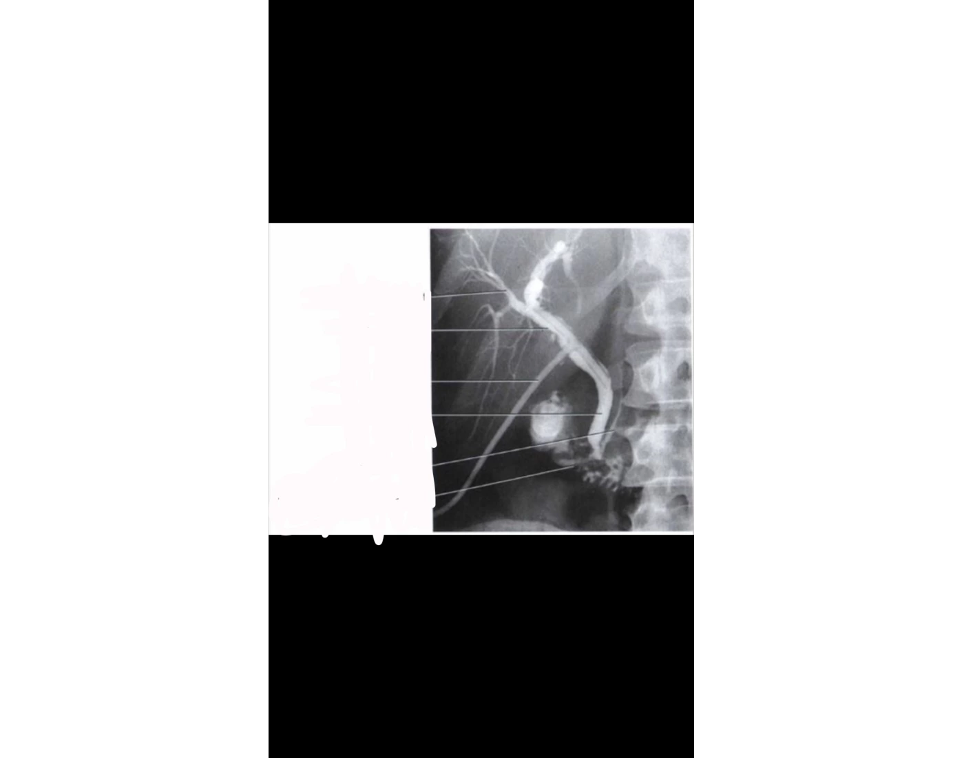 Intraoperative Cholangiogram And T Tube Procedure Quiz